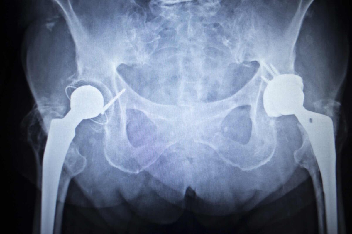 Marion man claims surgeon botched hip procedure - Ocala-News.com