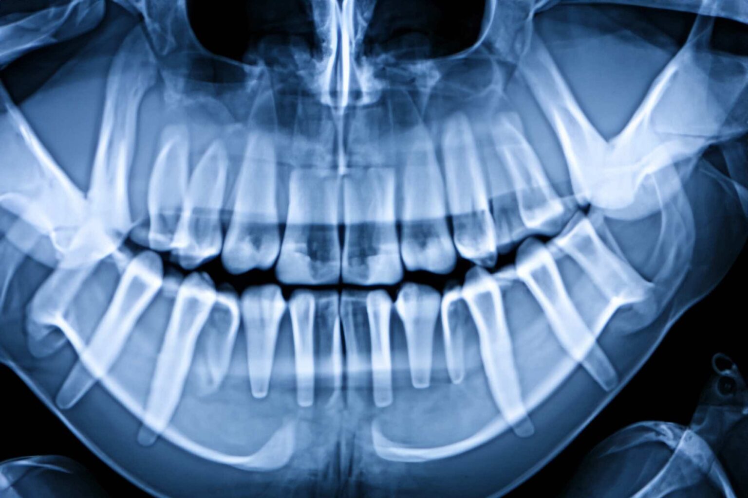 Patient claims Ocala dentist broke jaw during wisdom tooth extraction ...
