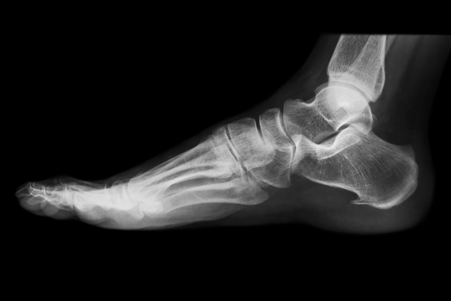 Patient says AdventHealth ER doctor's misdiagnosis led to fractures ...